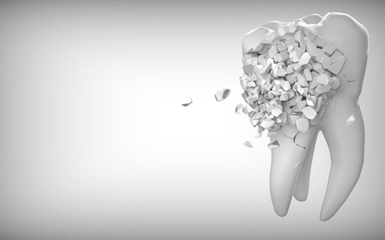 Learn How To Easily Identify A Cavity